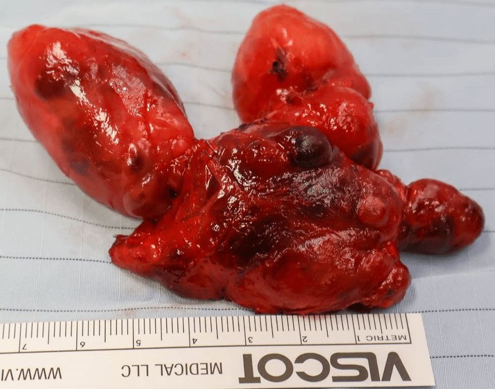 Thyroid Cancer | ENT Central